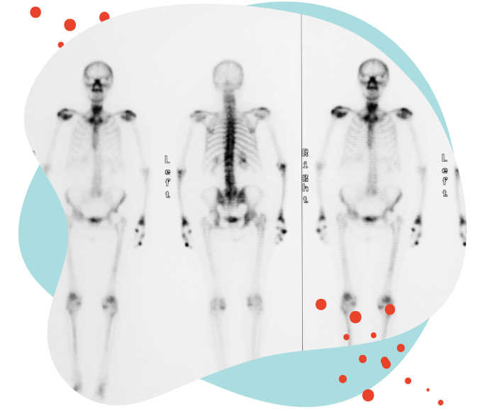 MRT | CT | PET-CT | Szintigraphie | Leben mit Brustkrebs